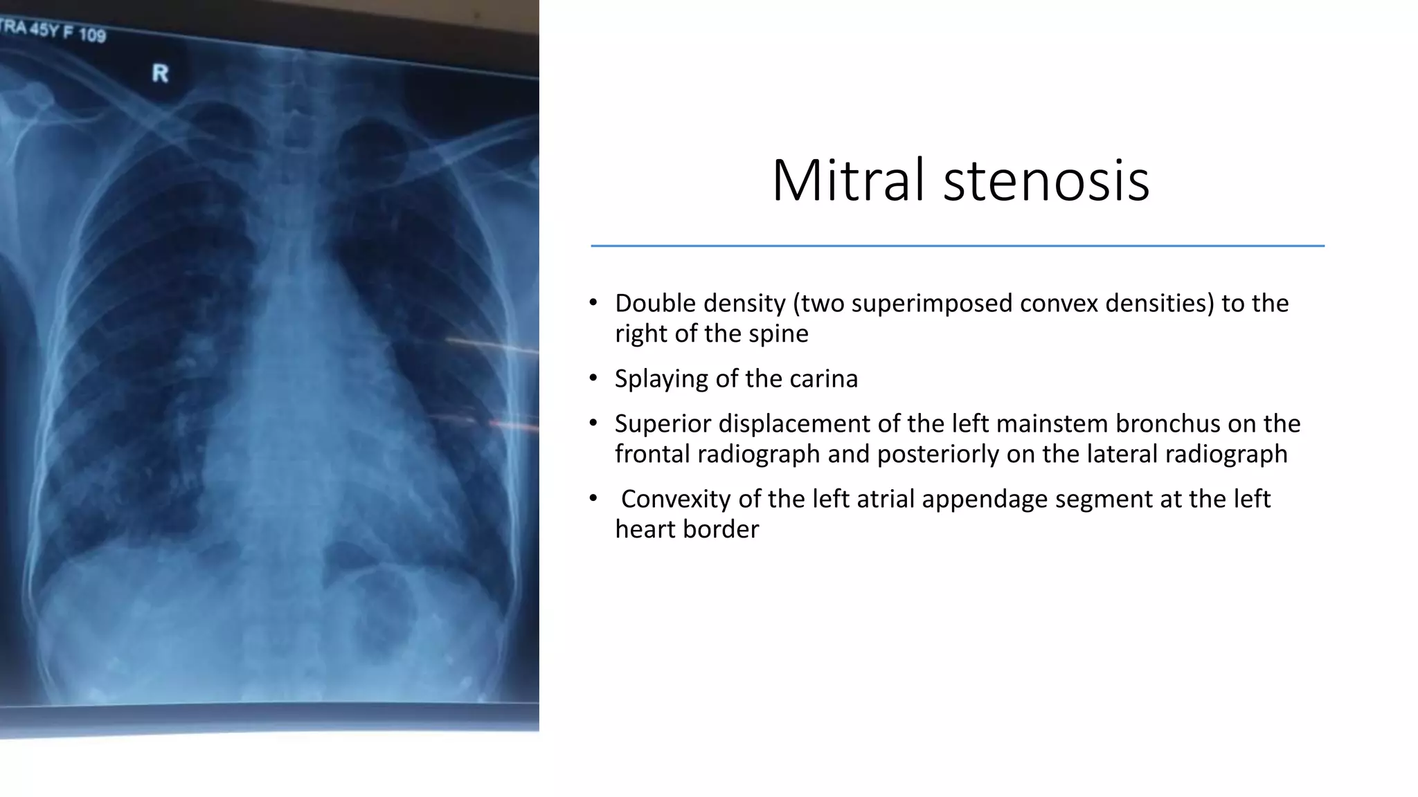 Diagnosis of heart diseases from chest x ray | PPTX