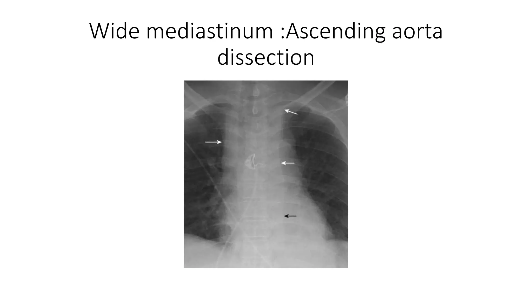 Diagnosis of heart diseases from chest x ray | PPTX