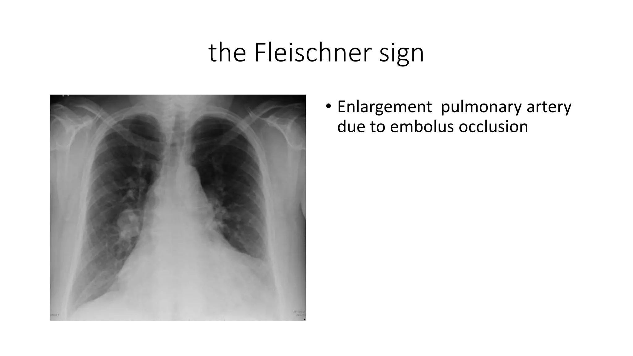 Diagnosis of heart diseases from chest x ray | PPTX