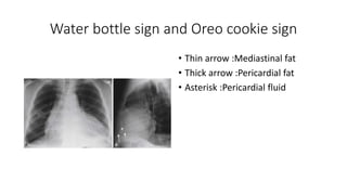 Diagnosis of heart diseases from chest x ray | PPTX