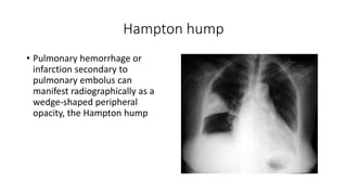 Diagnosis of heart diseases from chest x ray | PPTX