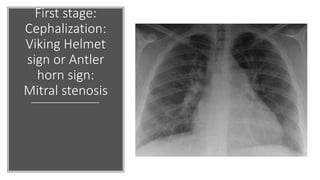Diagnosis of heart diseases from chest x ray | PPTX