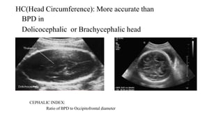 DIAGNOSIS OF IUGR in pregnancycriteria in India.pptx