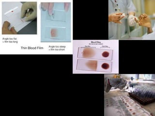 Diagnosis of malaria.ppt