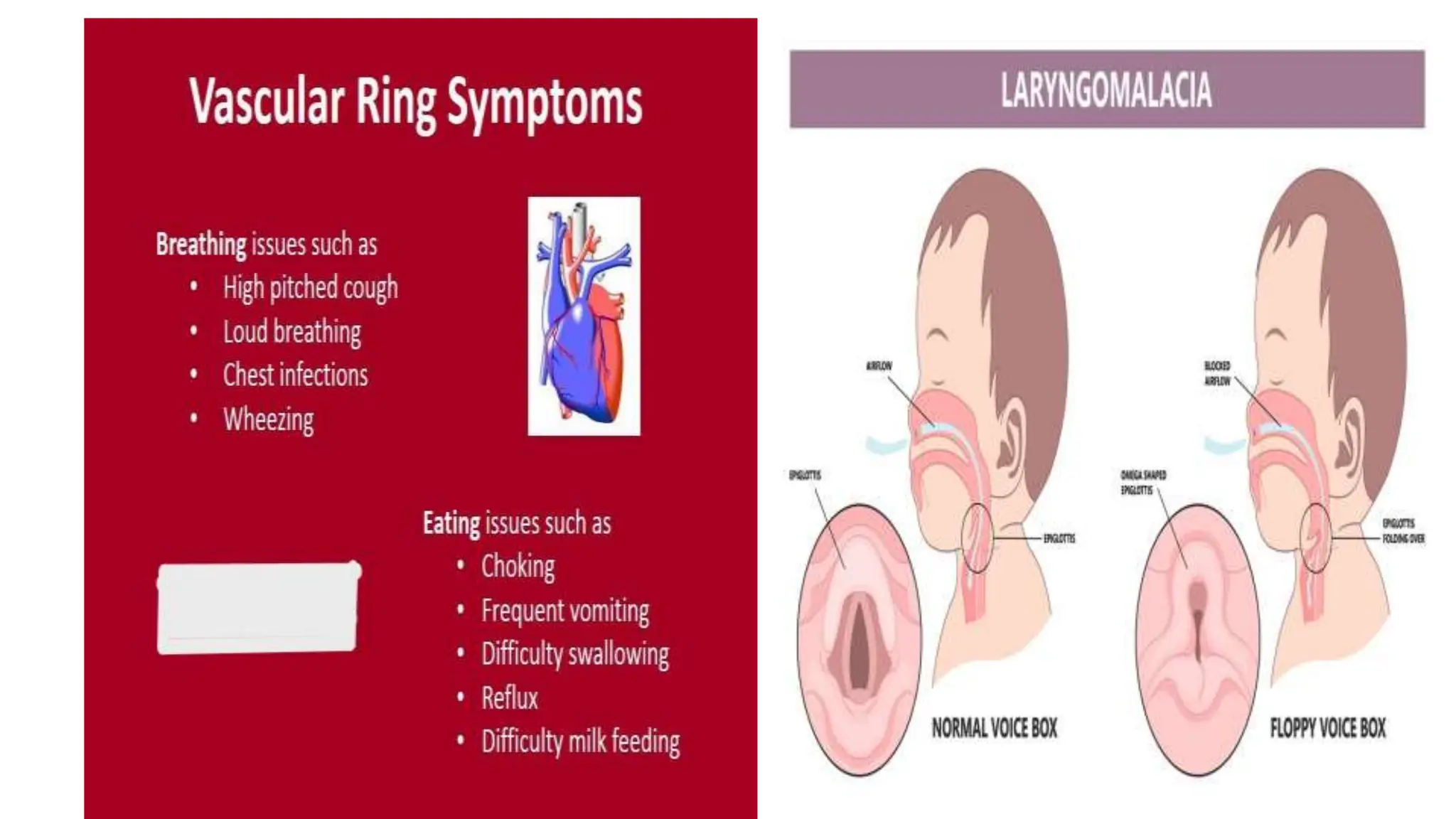 Diagnosis of Noisy Breathing in a 6-Year-Old Boy (1).pptx