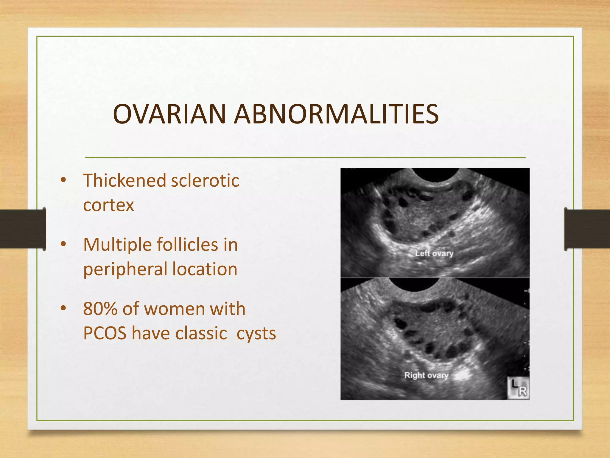 Diagnosis of pcos | PPTX