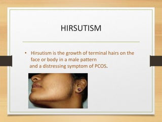 Diagnosis of pcos | PPTX