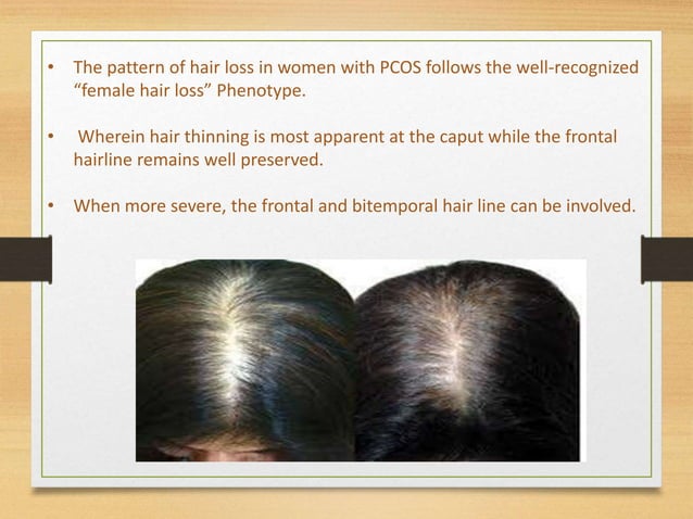 Diagnosis of pcos | PPTX | Hormonal Disorders | Endocrine and Metabolic ...