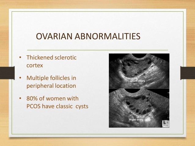 Diagnosis of pcos | PPTX | Hormonal Disorders | Endocrine and Metabolic Diseases
