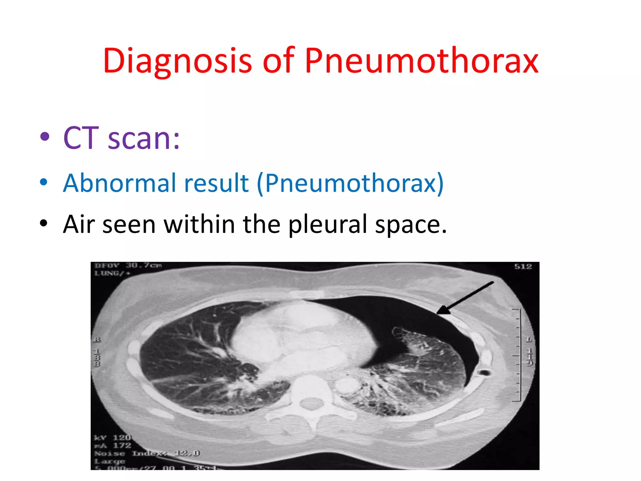 Diagnosis of pneumothorax | PPTX