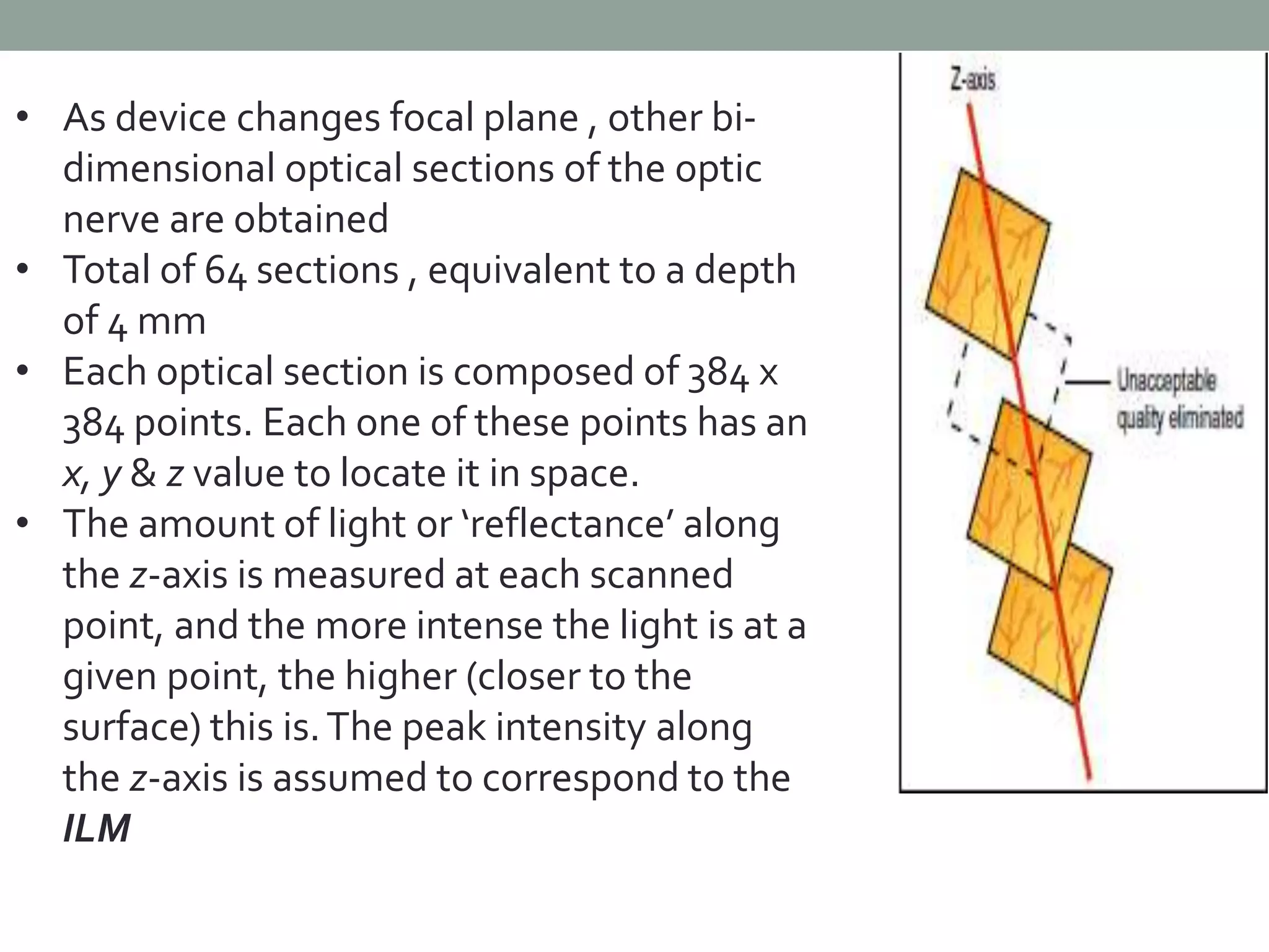 Diagnosis of pre perimetric glaucoma | PPTX
