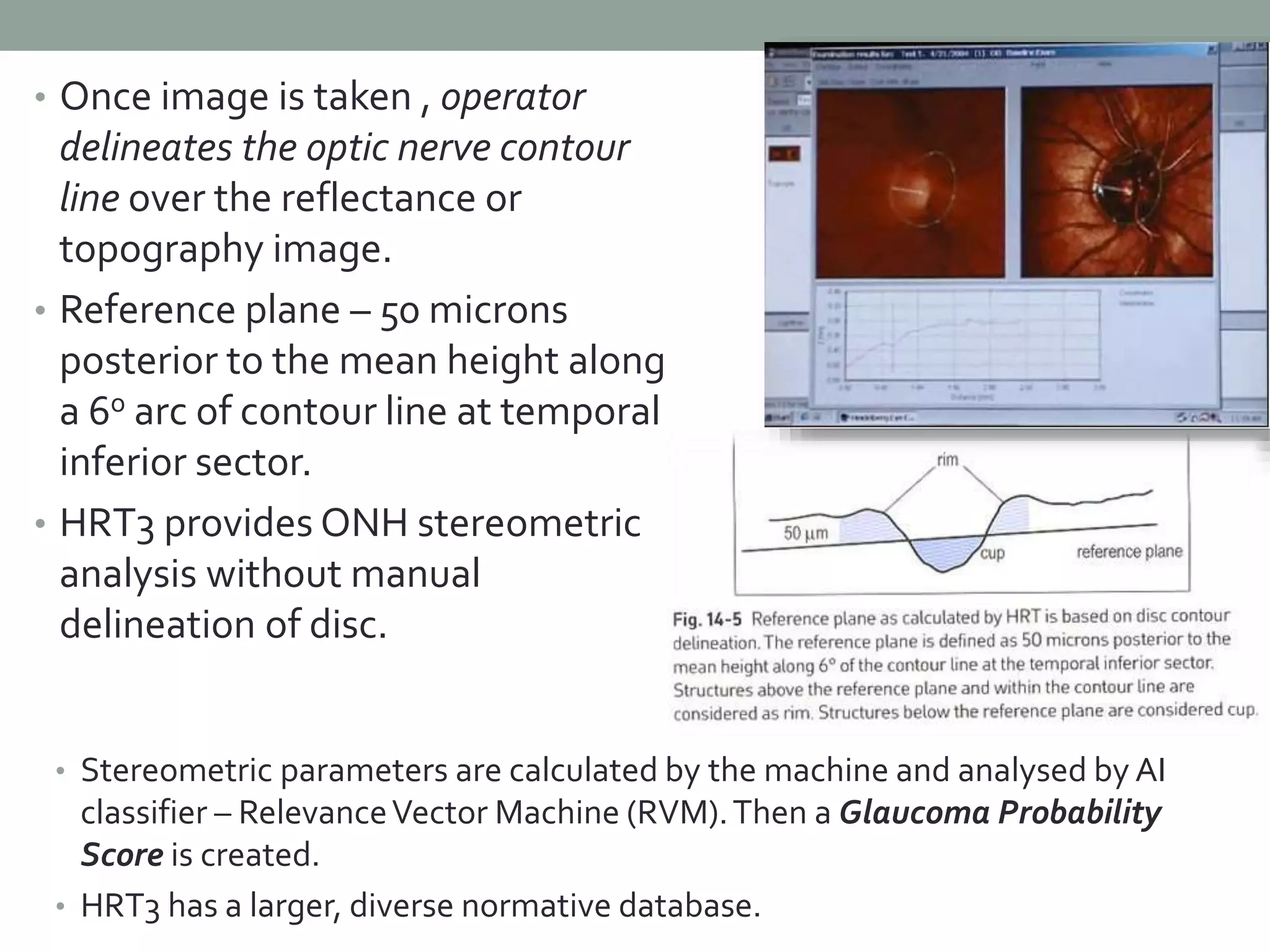 Diagnosis of pre perimetric glaucoma | PPTX