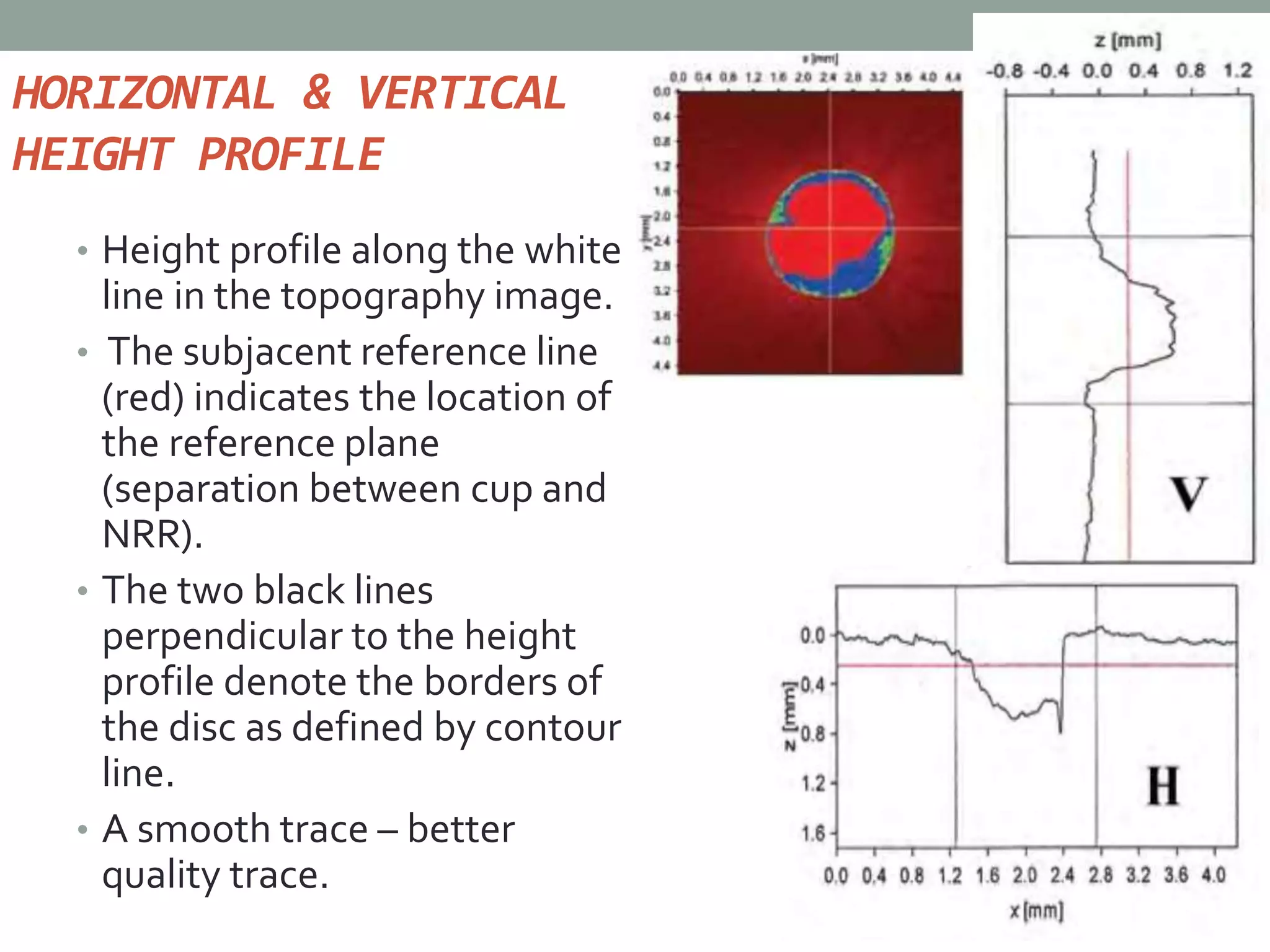 Diagnosis of pre perimetric glaucoma | PPTX
