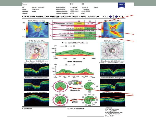 Diagnosis of pre perimetric glaucoma | PPTX