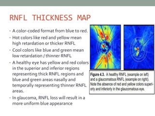 Diagnosis of pre perimetric glaucoma | PPTX