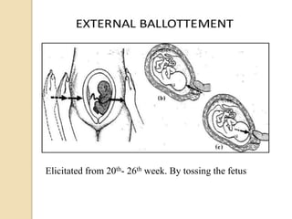 Ballottement Pregnancy