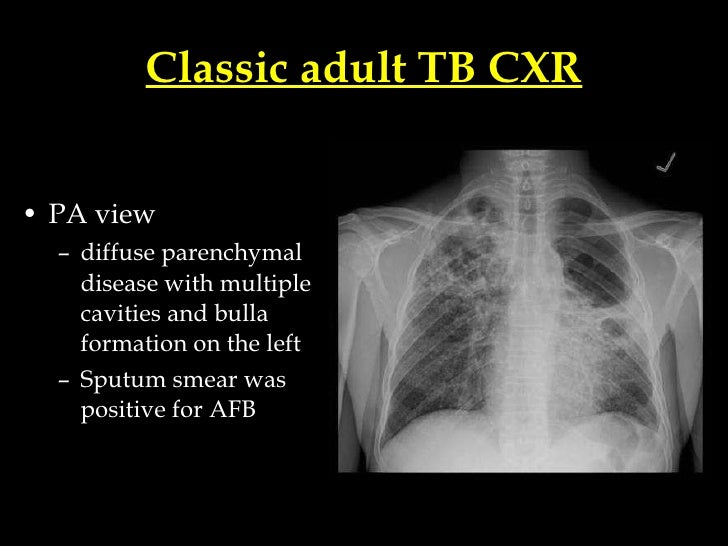 Diagnosis Of Pulmonary Tb