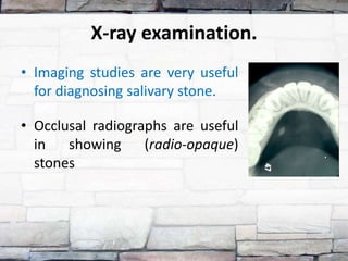 Diagnosis of salivary stones | PPTX
