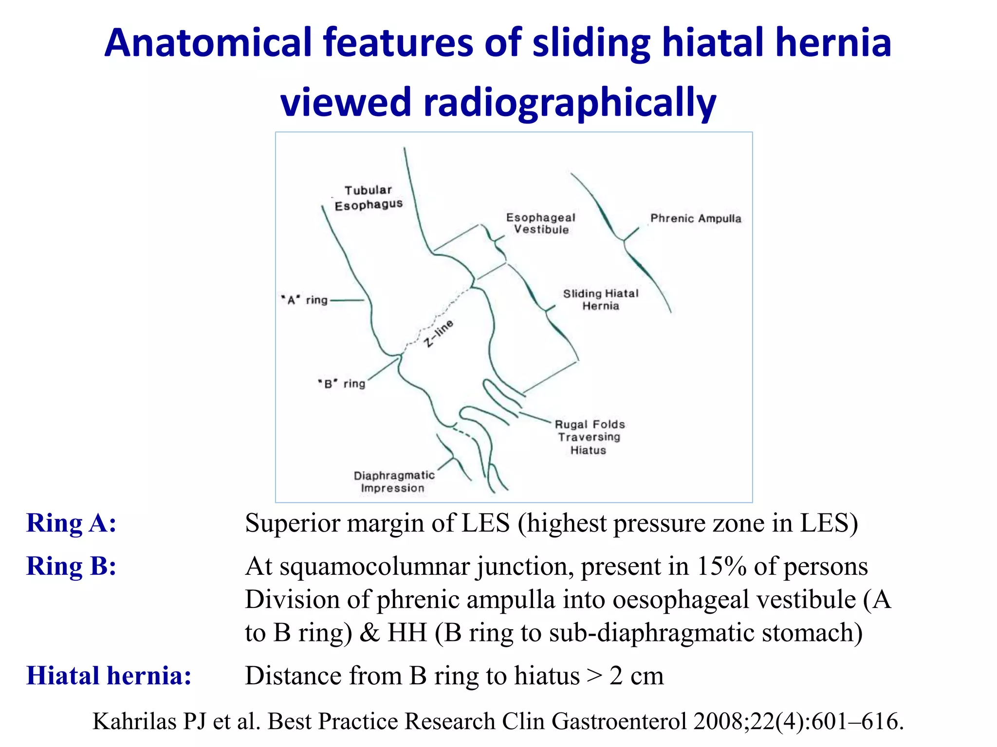 Diagnosis of sliding hiatal hernia | PPTX