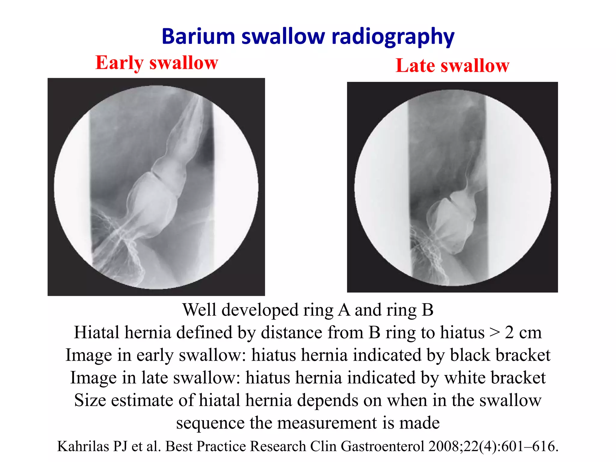 Diagnosis of sliding hiatal hernia | PPTX