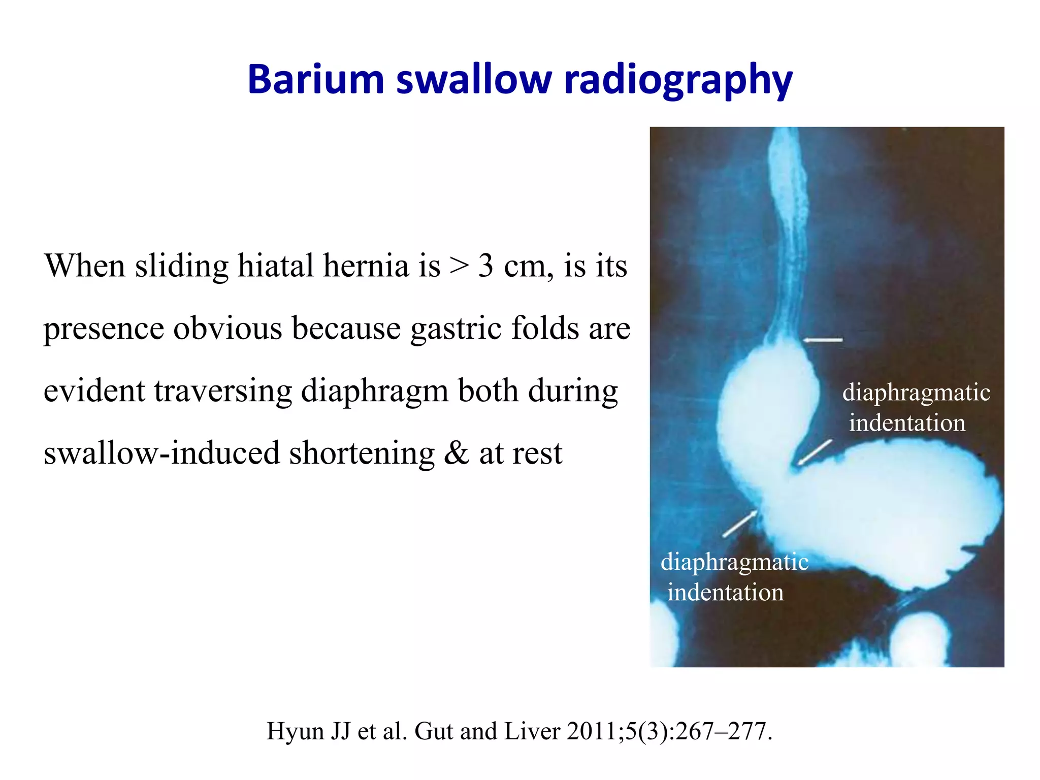 Diagnosis of sliding hiatal hernia | PPTX