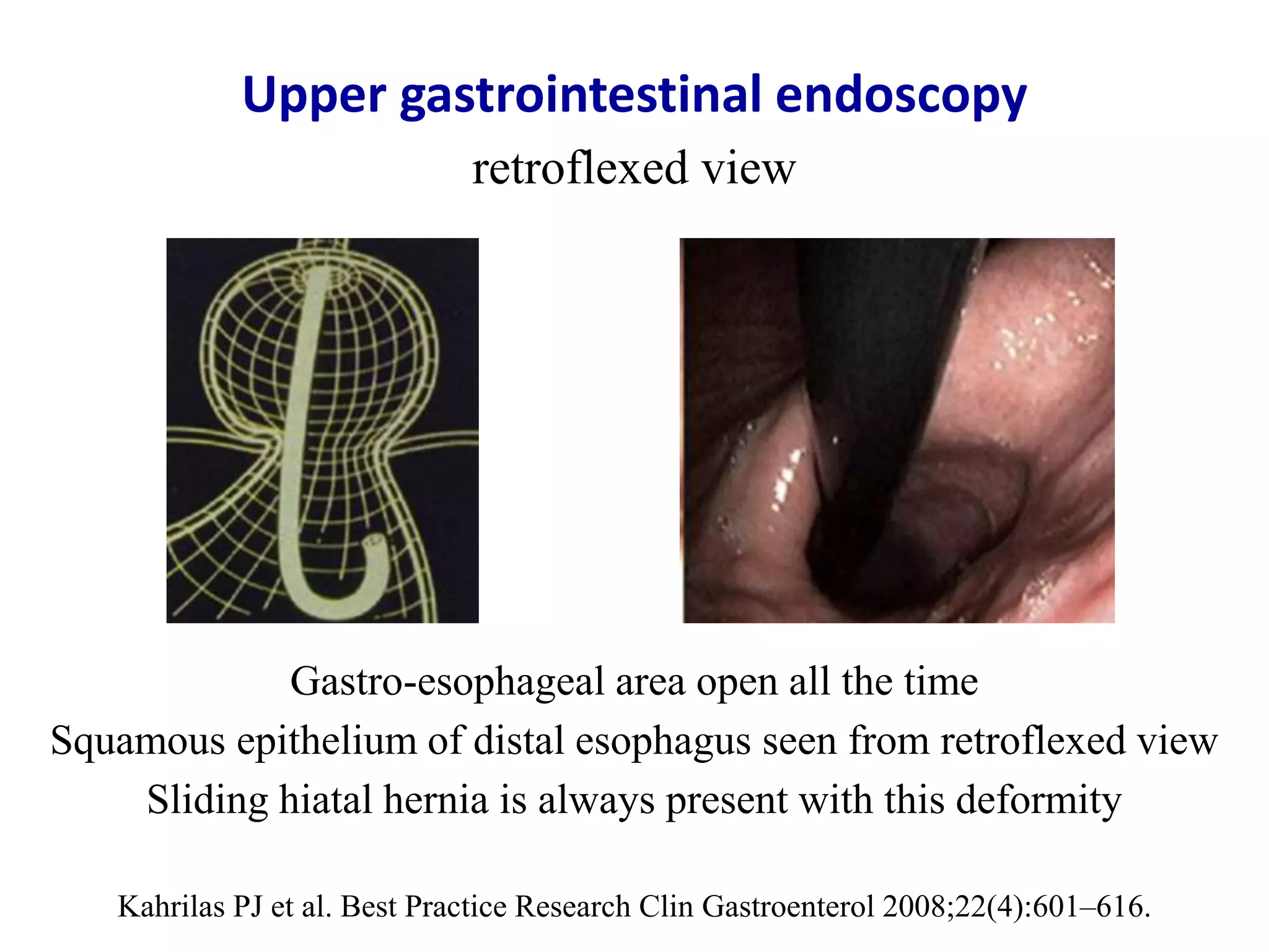 Diagnosis of sliding hiatal hernia | PPTX
