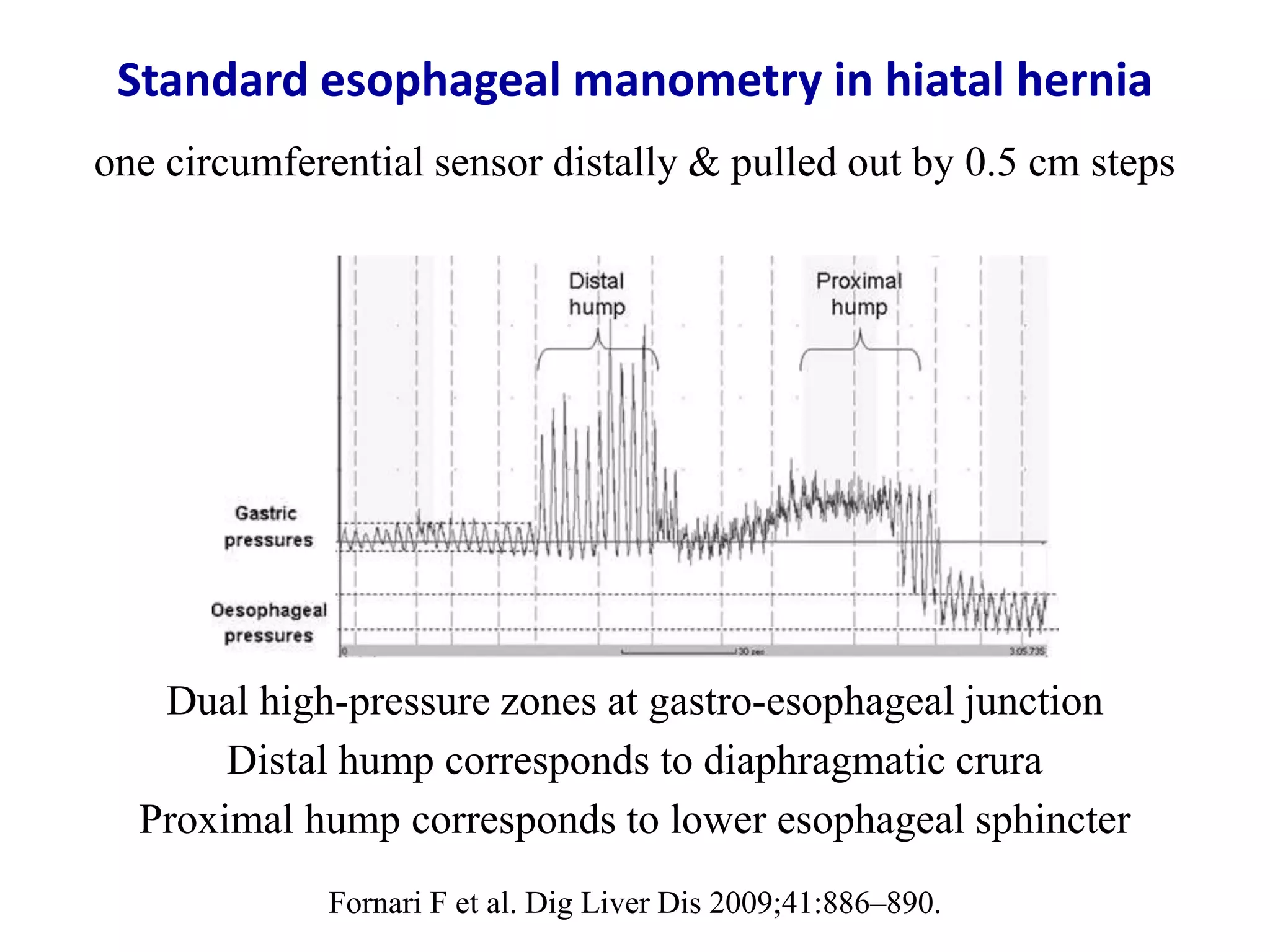 Diagnosis of sliding hiatal hernia | PPTX