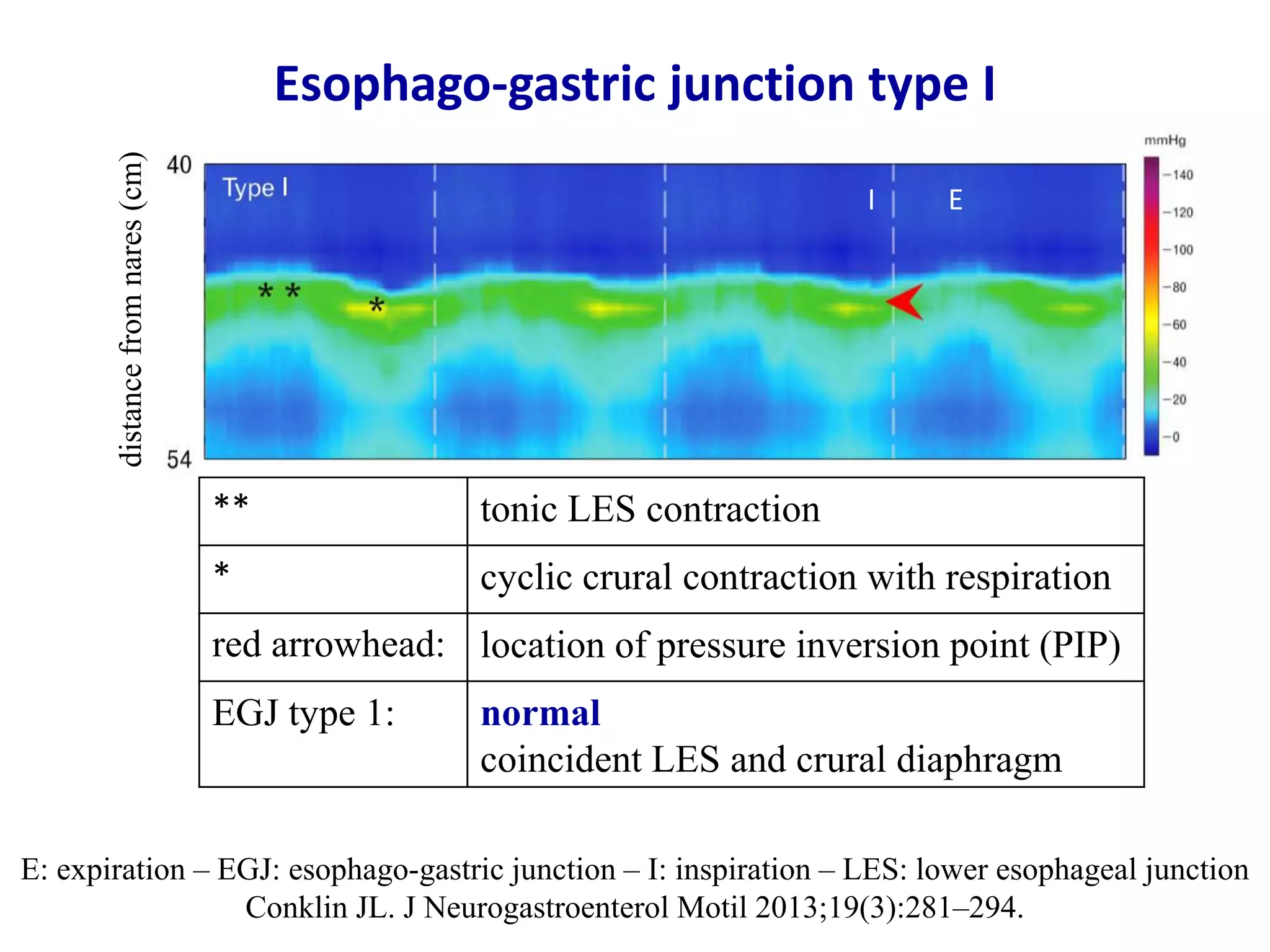Diagnosis of sliding hiatal hernia | PPTX