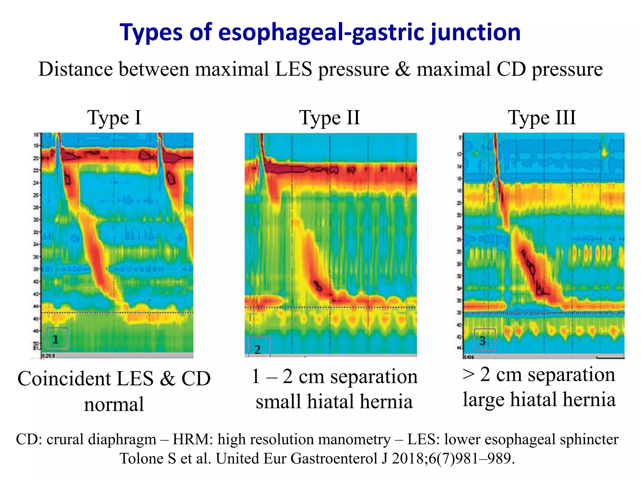 Diagnosis of sliding hiatal hernia | PPTX