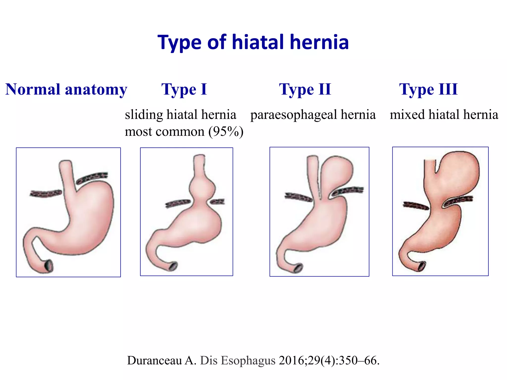 Diagnosis of sliding hiatal hernia | PPTX
