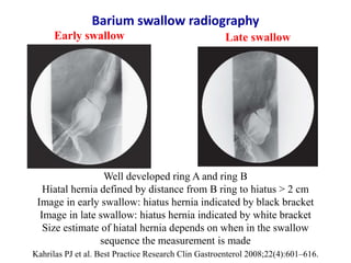 Diagnosis of sliding hiatal hernia | PPTX