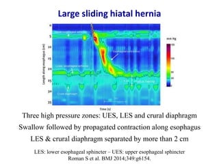 Diagnosis of sliding hiatal hernia | PPTX