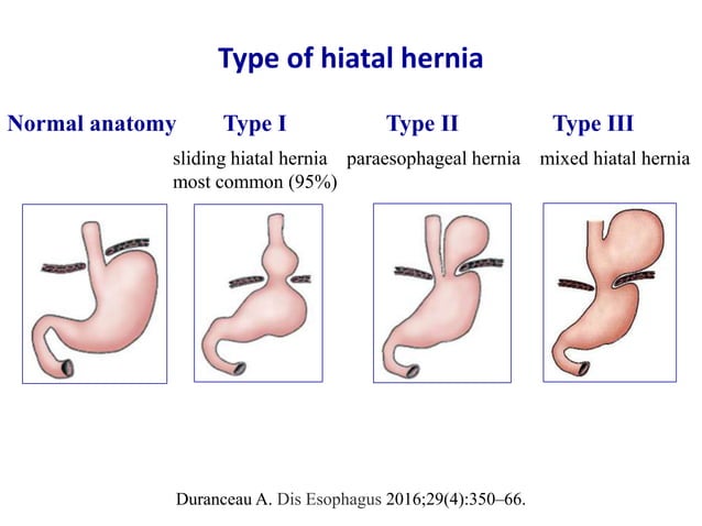 Diagnosis of sliding hiatal hernia | PPTX