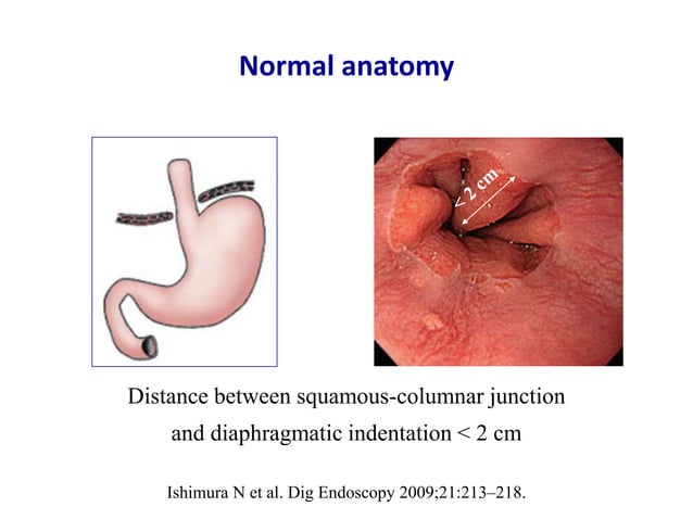 Diagnosis of sliding hiatal hernia | PPTX