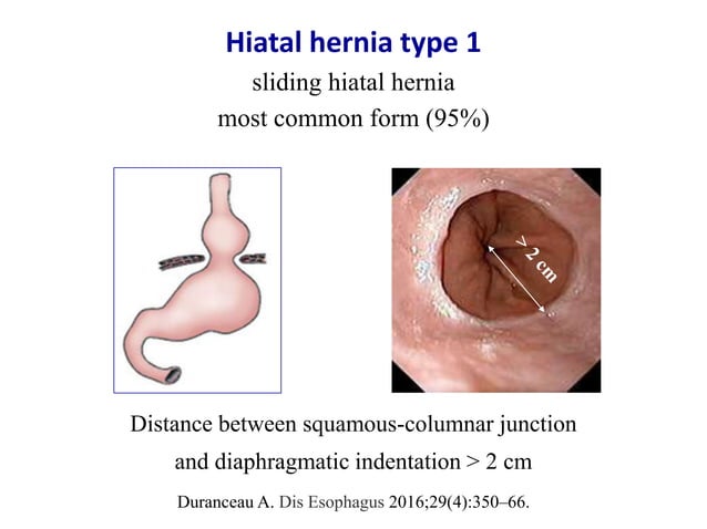 Diagnosis of sliding hiatal hernia | PPTX