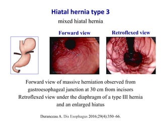 Diagnosis of sliding hiatal hernia | PPTX