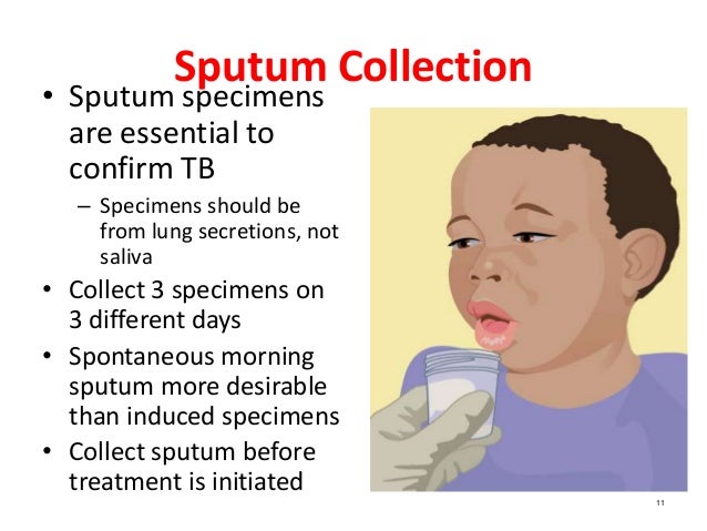 Diagnosis of Tuberculosis an Update