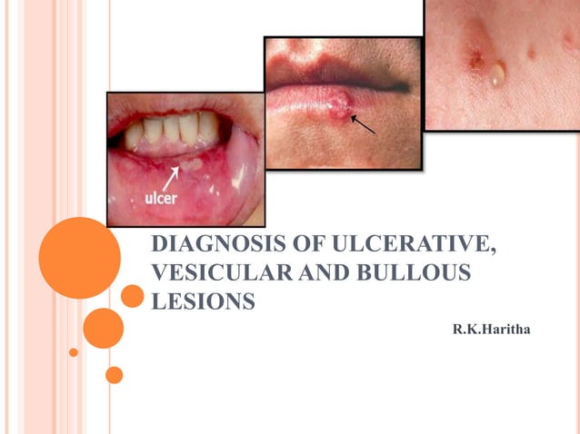 Diagnosis of ulcerative, vesicular and bullous lesion | PPTX | Dental ...