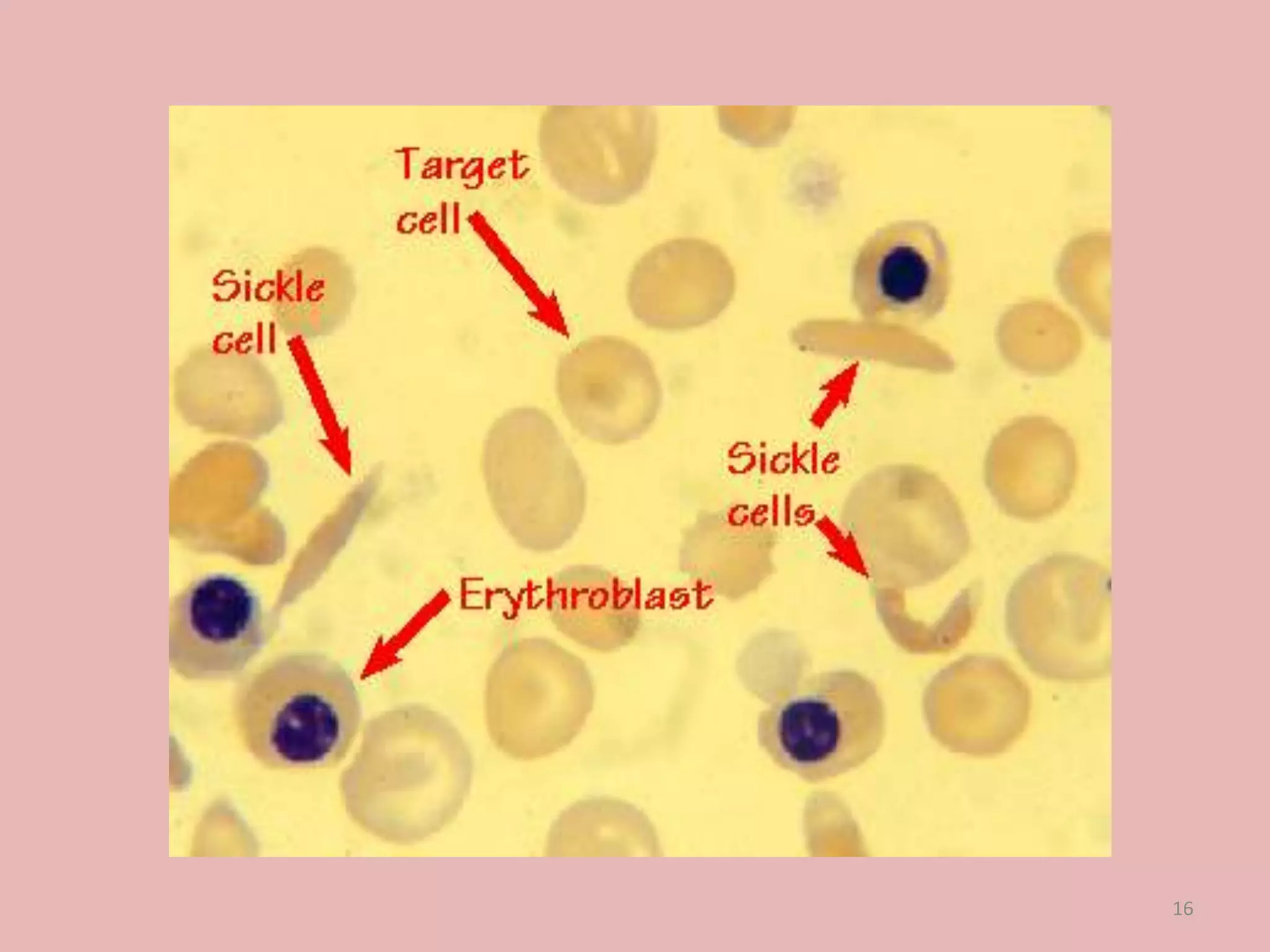 Diagnosis sickle cell anemia | PPTX