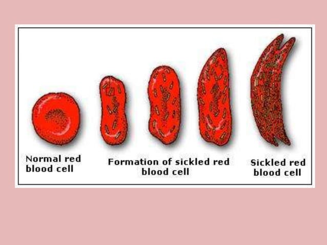 Diagnosis sickle cell anemia | PPTX | Blood Disorders | Diseases and ...