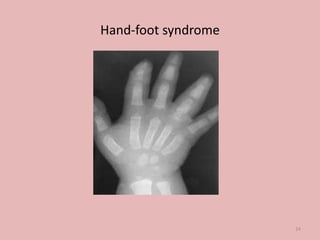 Sickle Cell Anemia Hand Foot Syndrome