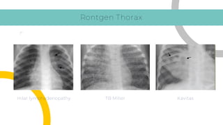 DIAGNOSIS TUBERKULOSIS ANAK DAN REMAJA-3.pdf