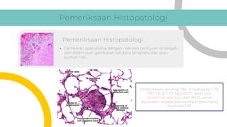 DIAGNOSIS TUBERKULOSIS ANAK DAN REMAJA-3.pdf