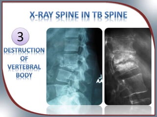 Diagnosis of Spine Tuberculosis | PPTX