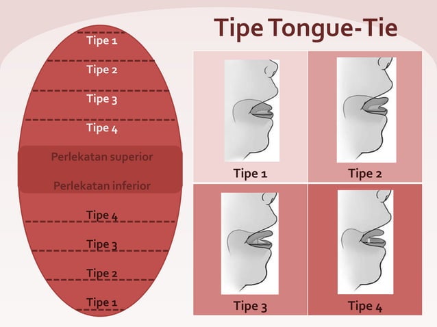 Diagnosis tongue tie & indikasi frenektomi | PPTX