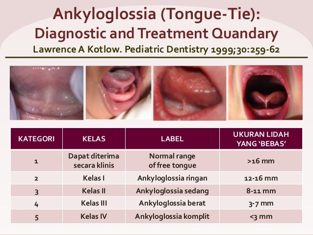 Diagnosis tongue tie & indikasi frenektomi