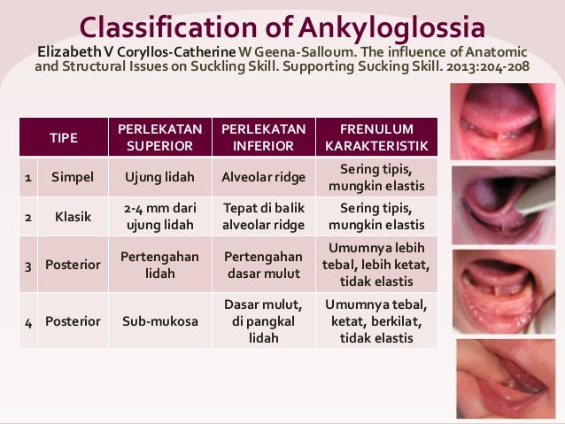 Diagnosis tongue tie & indikasi frenektomi
