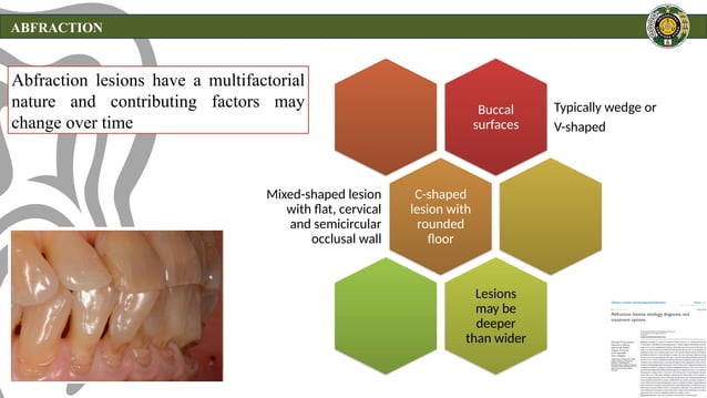 DIAGNOSIS TOOTH WEAR chemical and physical | PPT | Free download