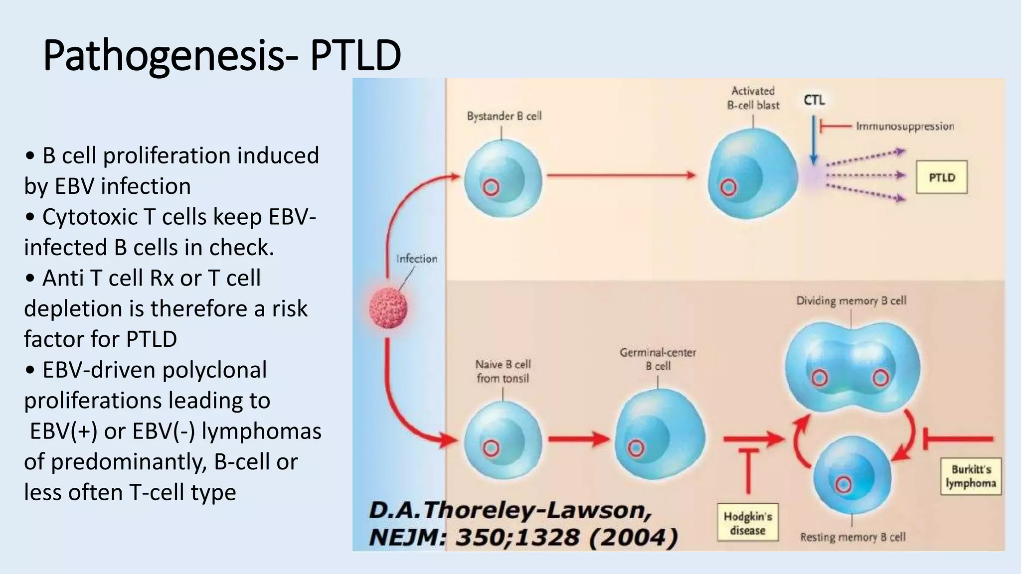 Diagnosis & treatment of ptld dr keniz | PPT