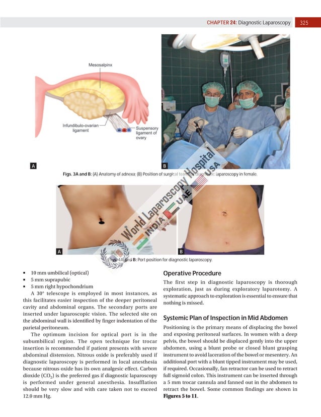 Diagnostic Laparoscopy | PDF